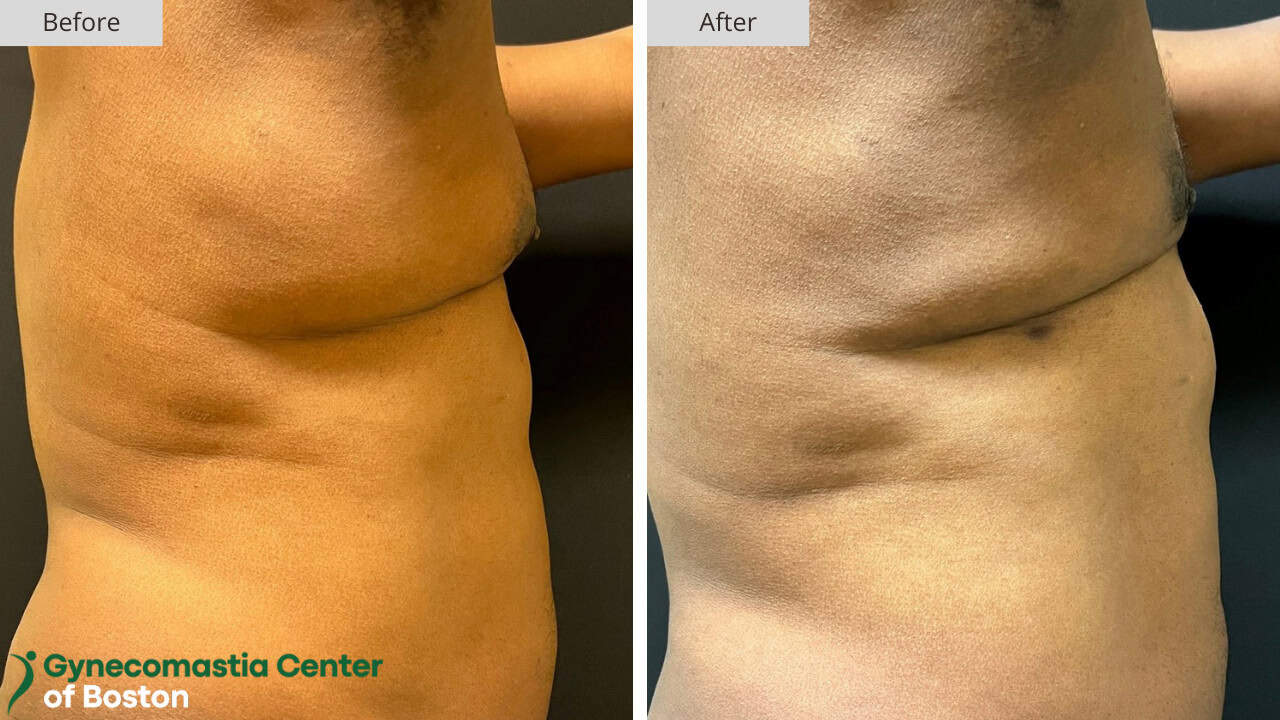 Boston Gynecomastia Surgery: Before & After Results